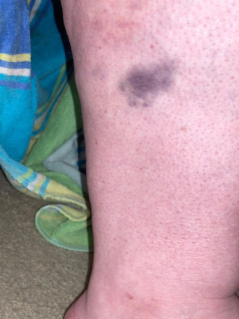 What A Fall Does To An Infinifat Body – Finding Evie